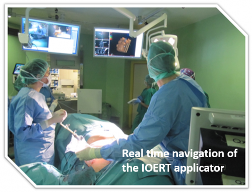 Intraoperative Radiation Therapy | BiiG